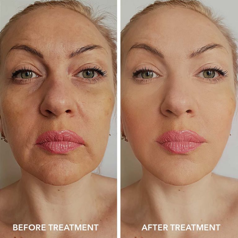 Sunekos Skin Treatment - Heswall Laser Clinic